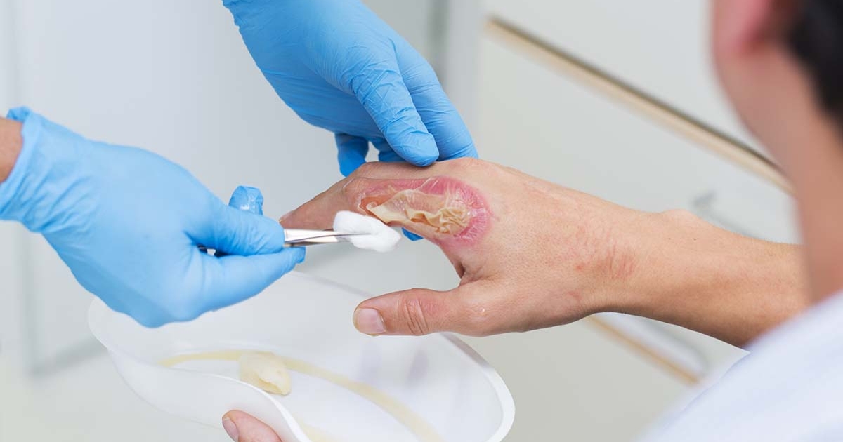 Haavahoito-osaamisen vahvistaminen lähihoitajakoulutuksessa - Laurea ...